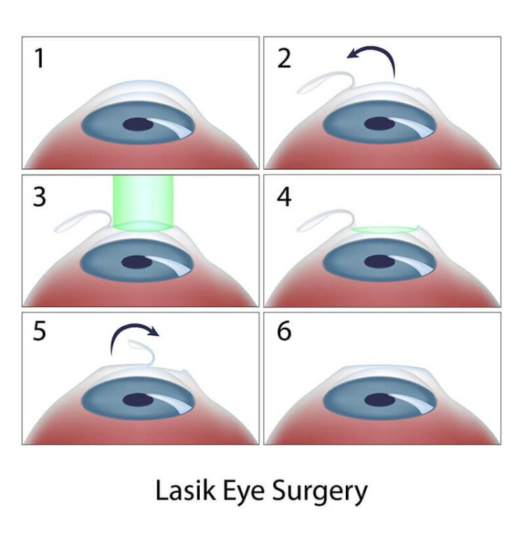LASIK Dayton | LASIK Eye Surgery Dayton, OH | Mehan Eye